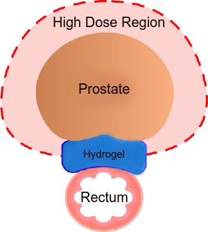 Rectal Spacers | Fox Chase Cancer Center - Philadelphia PA