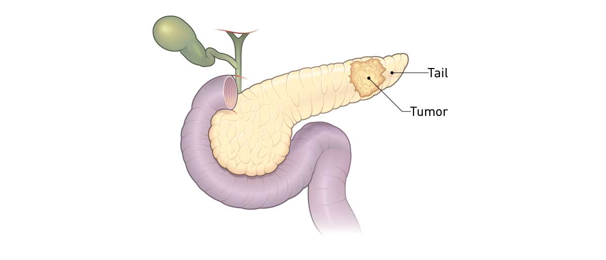 Surgery for Pancreatic Cancer | Fox Chase Cancer Center - Philadelphia PA