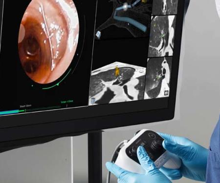 Robotic Bronchoscopy | Fox Chase Cancer Center - Philadelphia PA